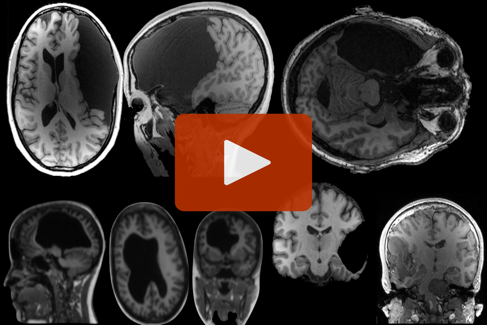 Why you get brain fog (Explained)